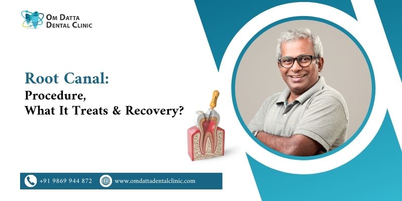 Root Canal Procedure What It Treats And Recovery 0787